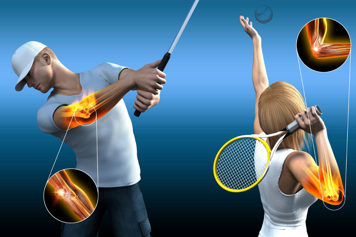 Entendendo a Epicondilite e seu Tratamento Fisioterápico - Fisio ...